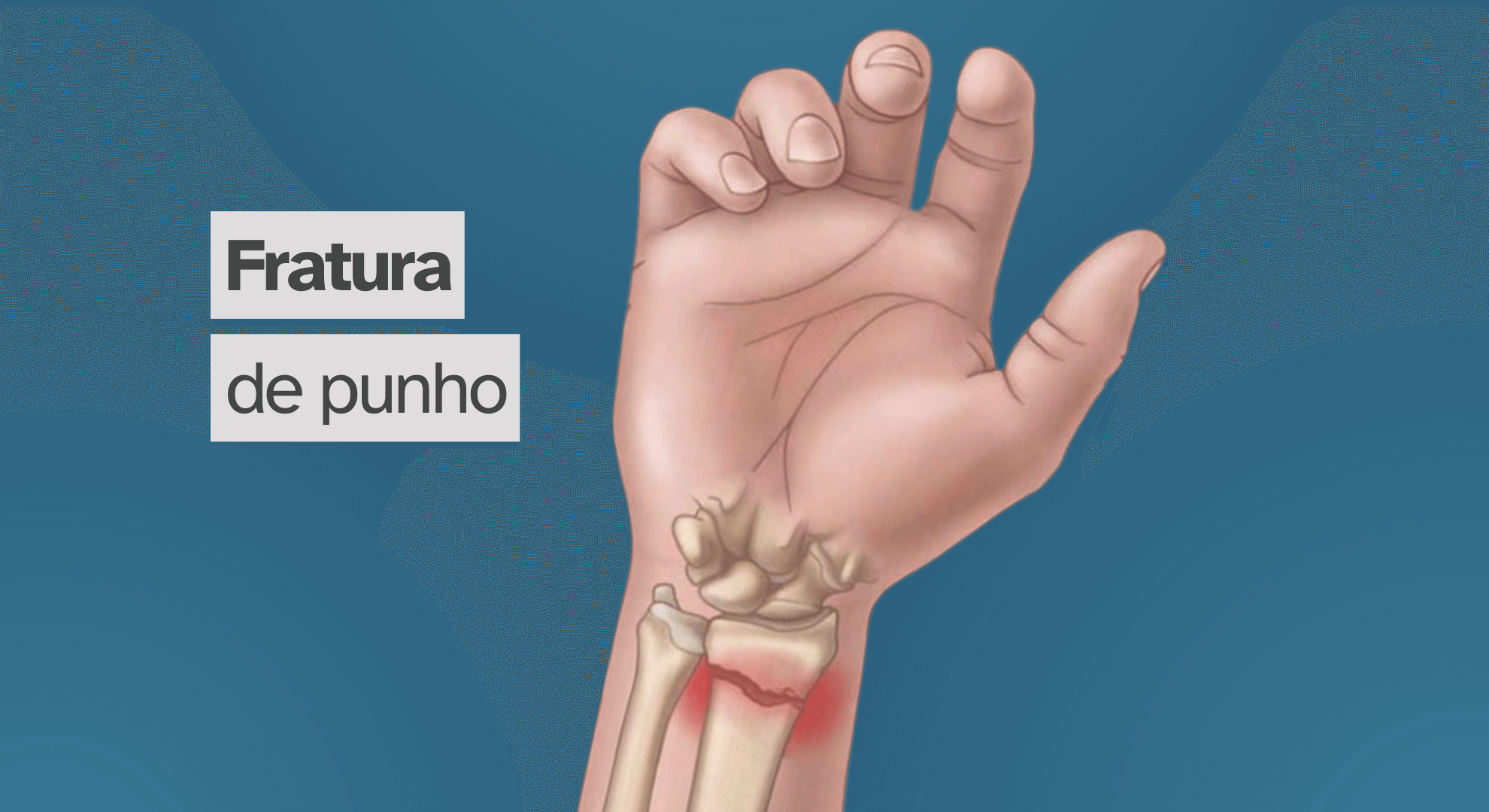 Fratura de punho - Blog - Dr Luiz Brito